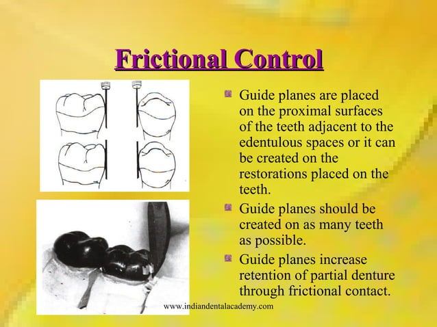 Design consideration in reducing stress in rpd/ oral surgery courses ...