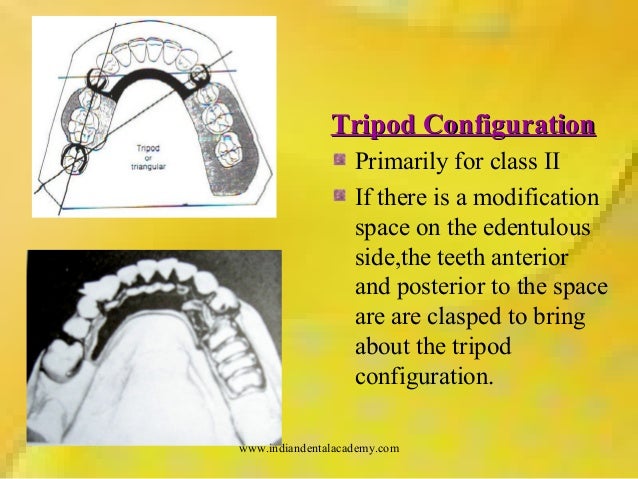 Design consideration in reducing stress in rpd/ oral surgery courses