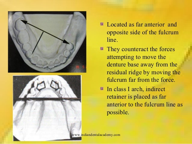 Design consideration in reducing stress in rpd/ oral surgery courses