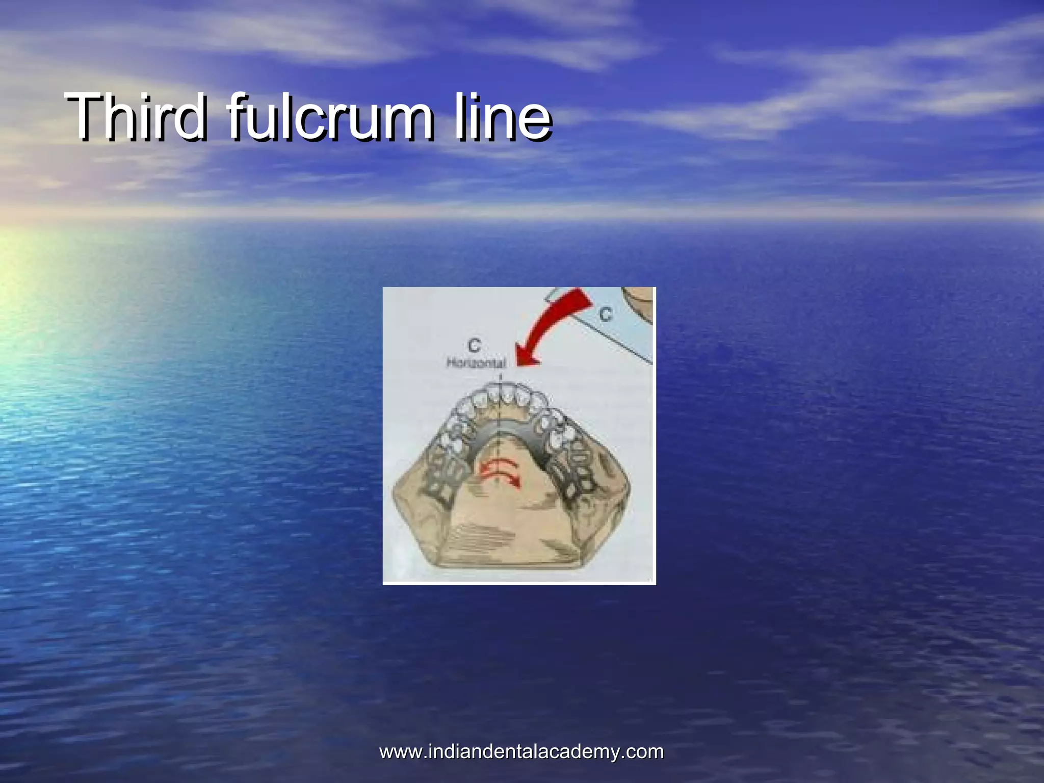 Design considerations for a distal extension rpd/prosthodontic courses ...