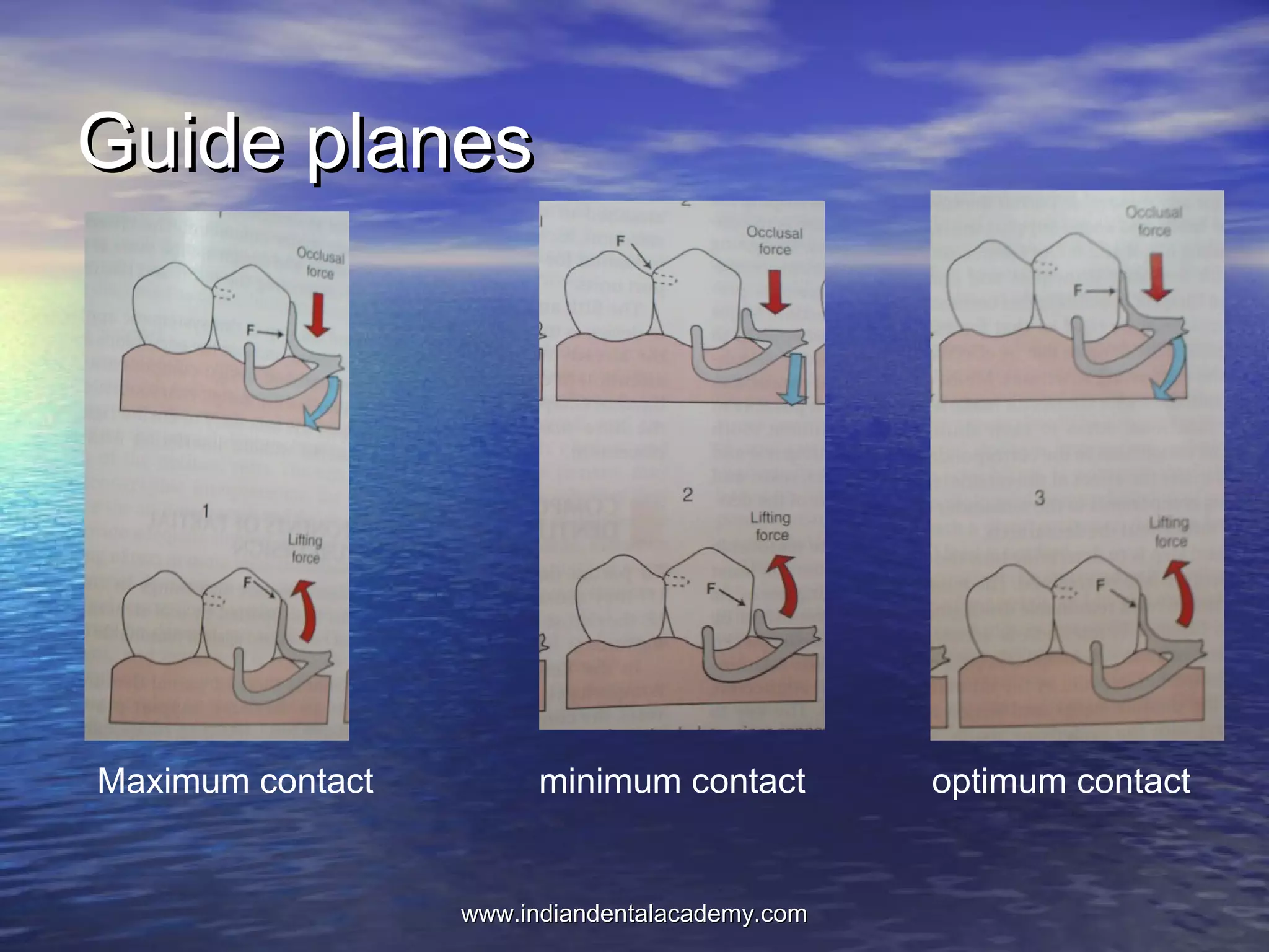 Design considerations for a distal extension rpd/prosthodontic courses ...