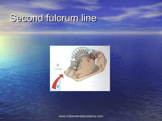 Design considerations for a distal extension rpd/prosthodontic courses ...
