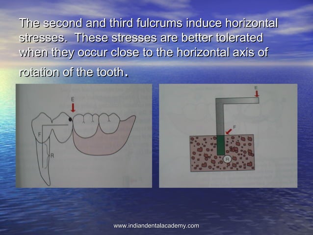Design considerations for a distal extension rpd/prosthodontic courses ...