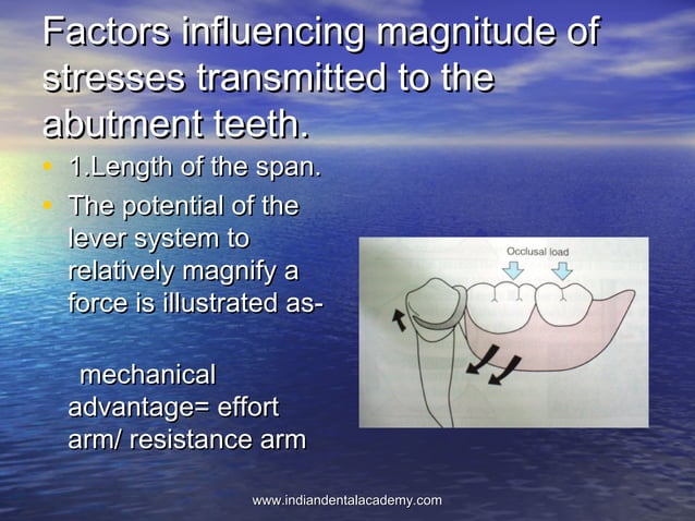 Design considerations for a distal extension rpd/prosthodontic courses ...
