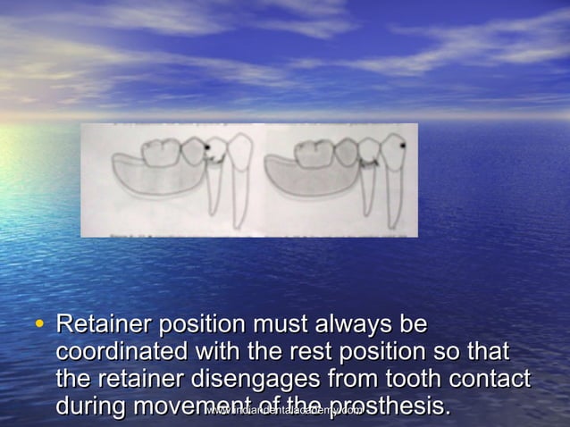 Design considerations for a distal extension rpd/prosthodontic courses ...