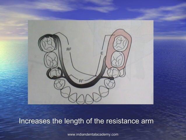 Design considerations for a distal extension rpd/prosthodontic courses ...