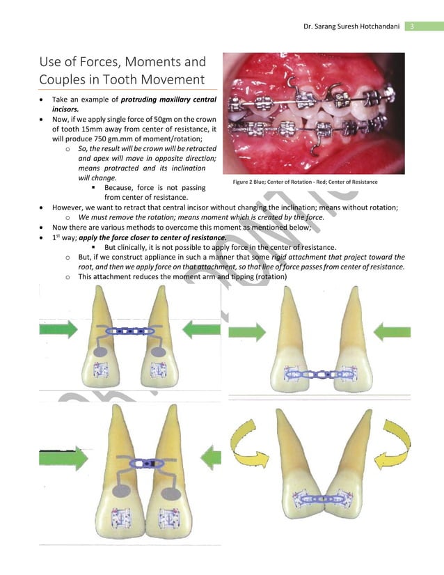 Design Factors in Orthodontic Appliance | PDF | Dental Health ...