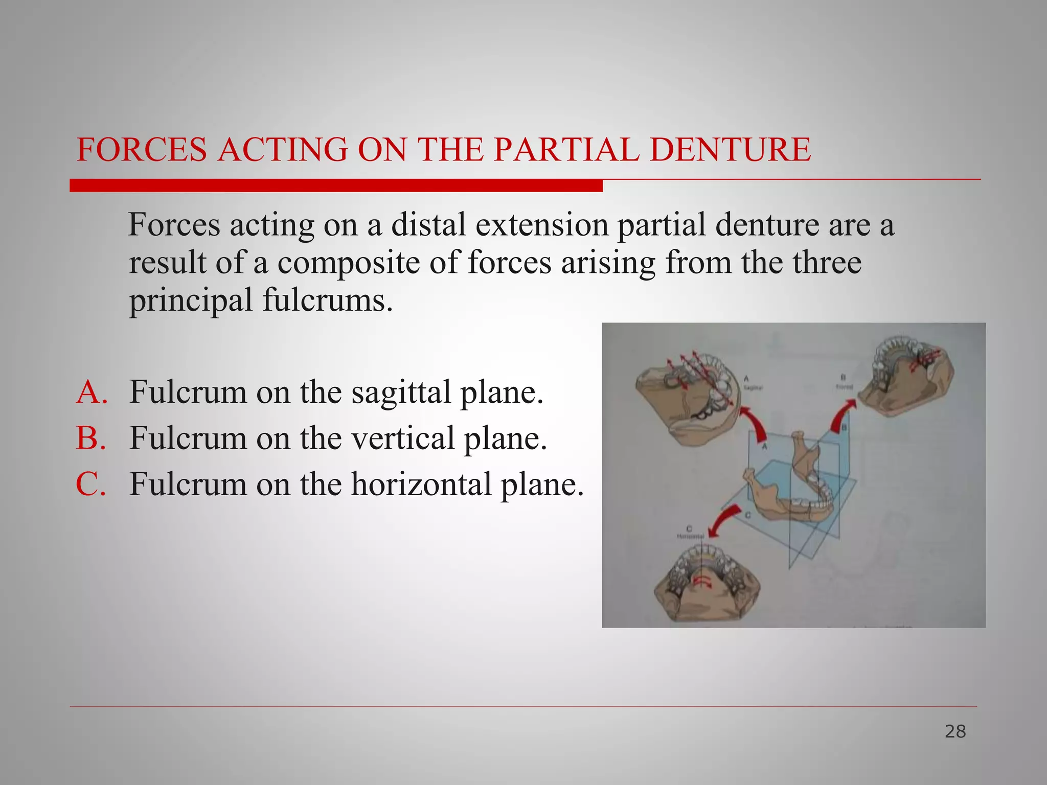 Designing for kennedy class i and class ii | PPT