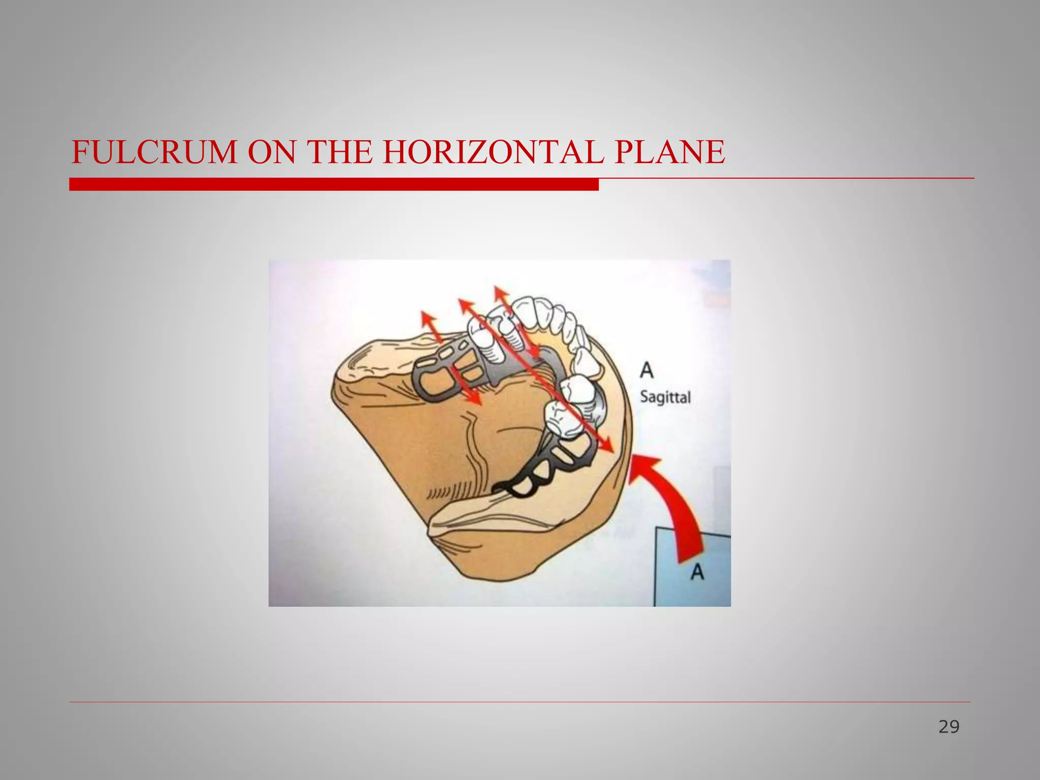 Designing for kennedy class i and class ii | PPT