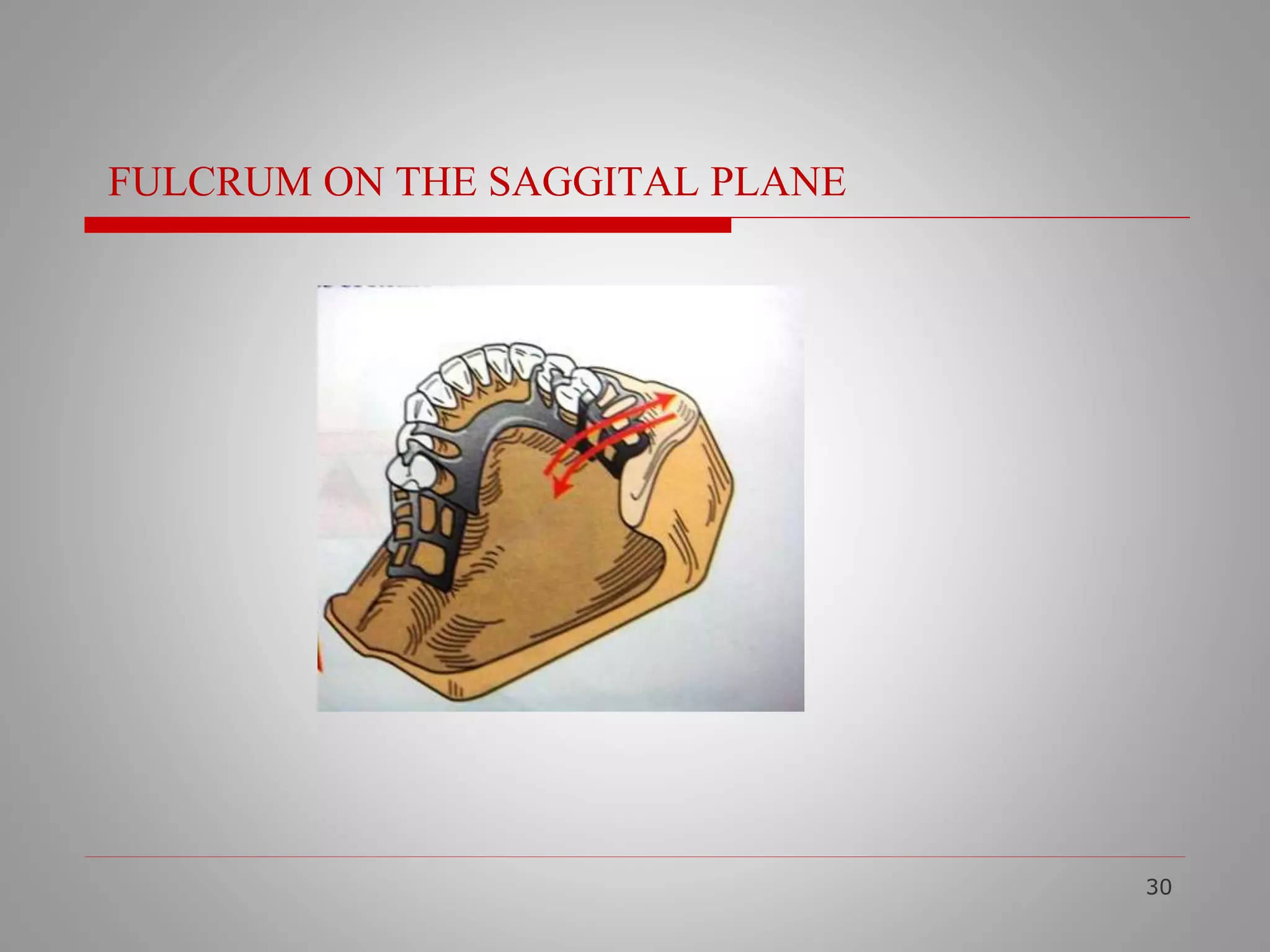 Designing for kennedy class i and class ii | PPT