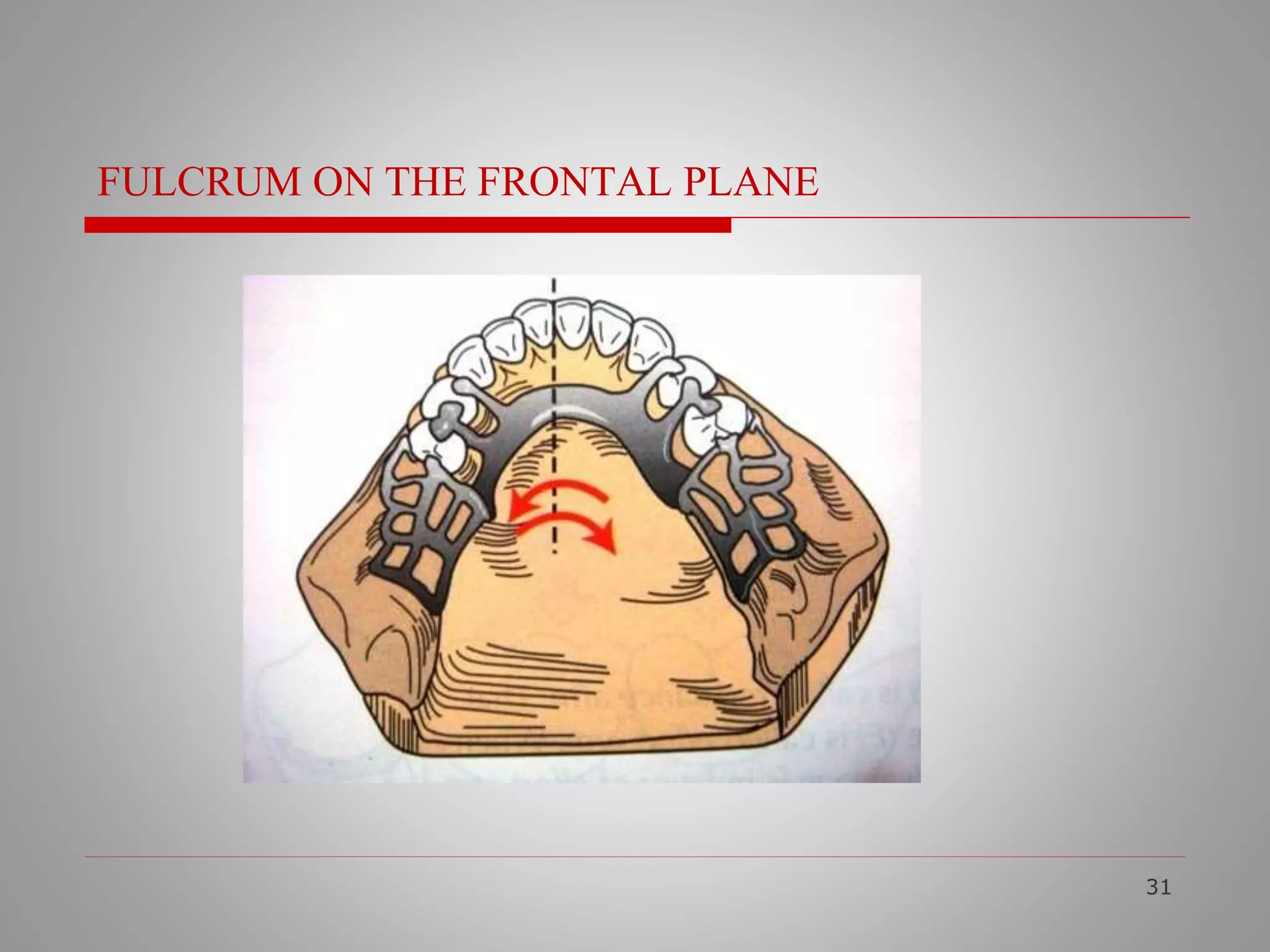Designing For Kennedy Class I And Class Ii Ppt