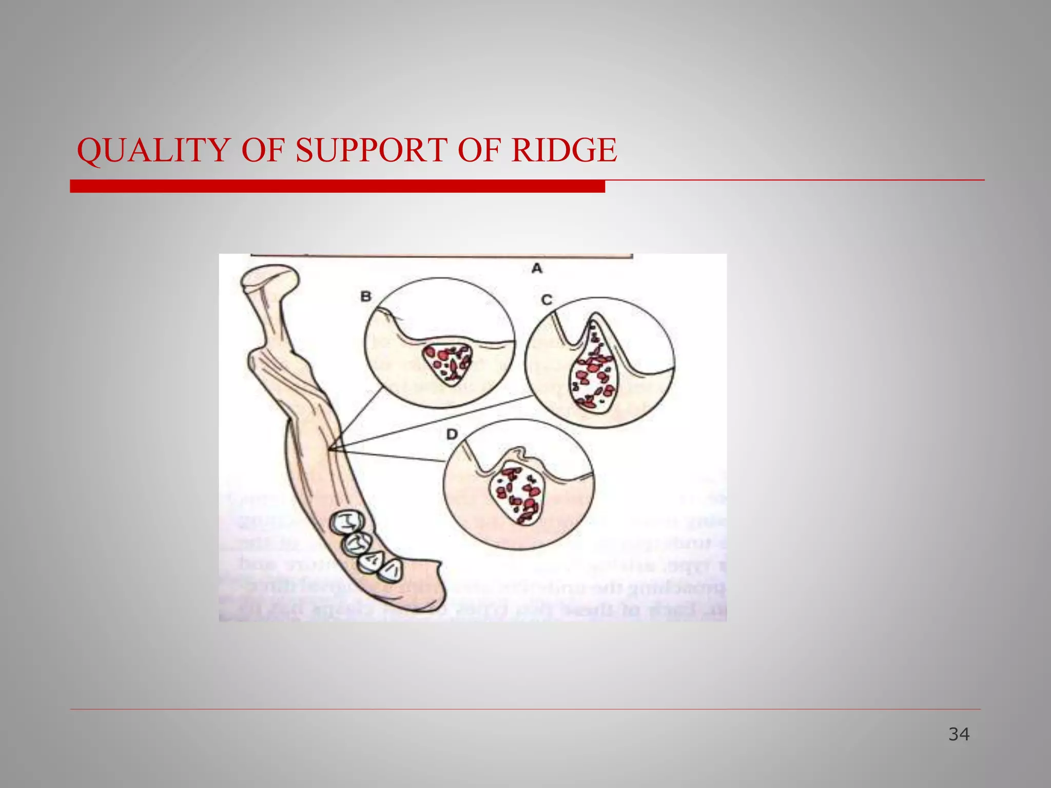 Designing For Kennedy Class I And Class Ii Ppt