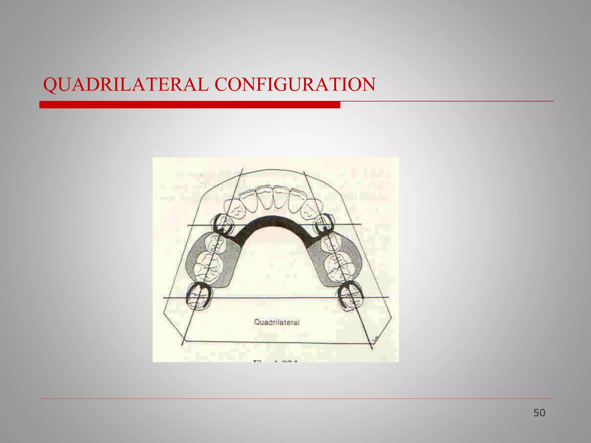 Designing for kennedy class i and class ii | PPT