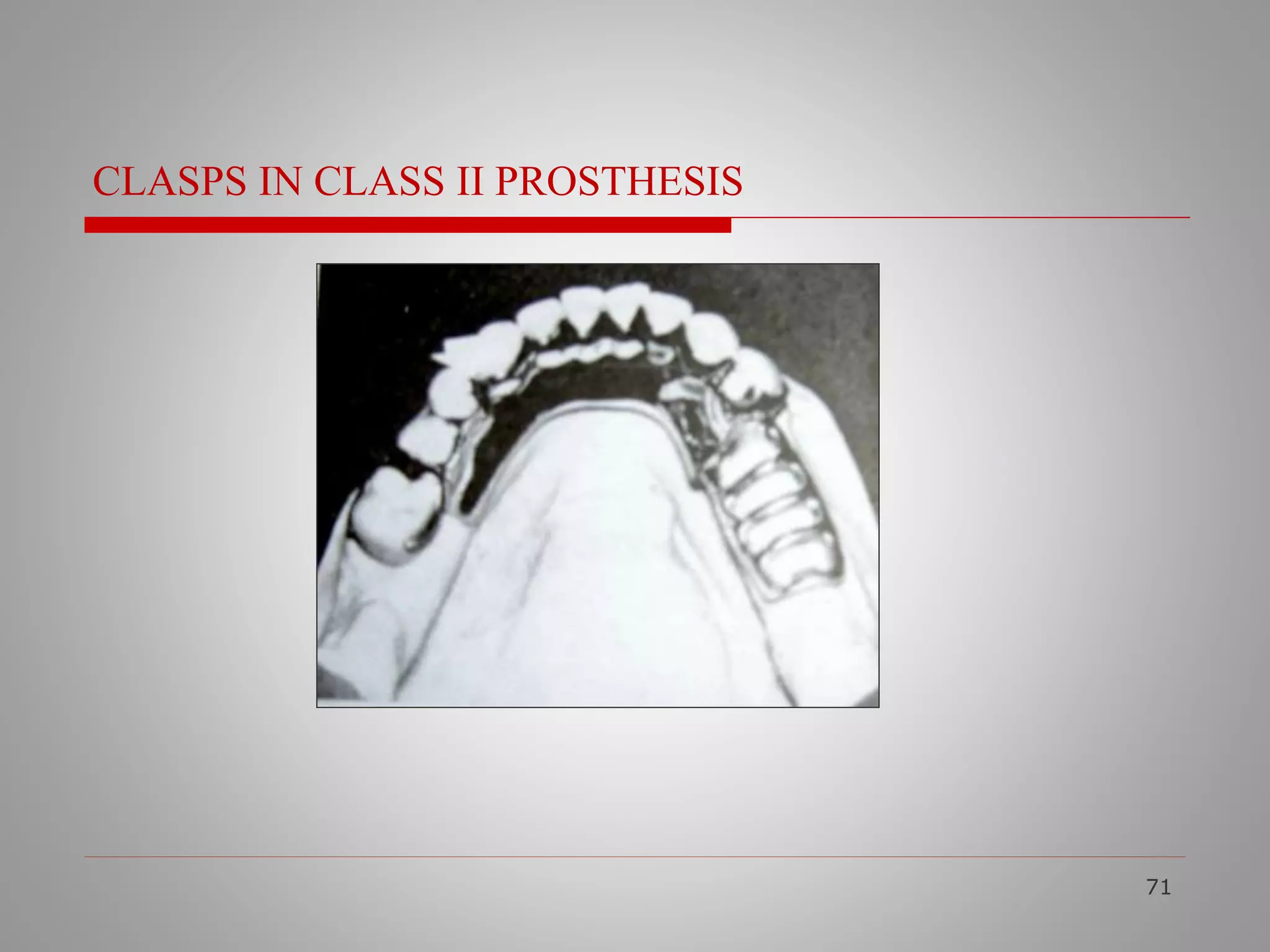 Designing for kennedy class i and class ii | PPT