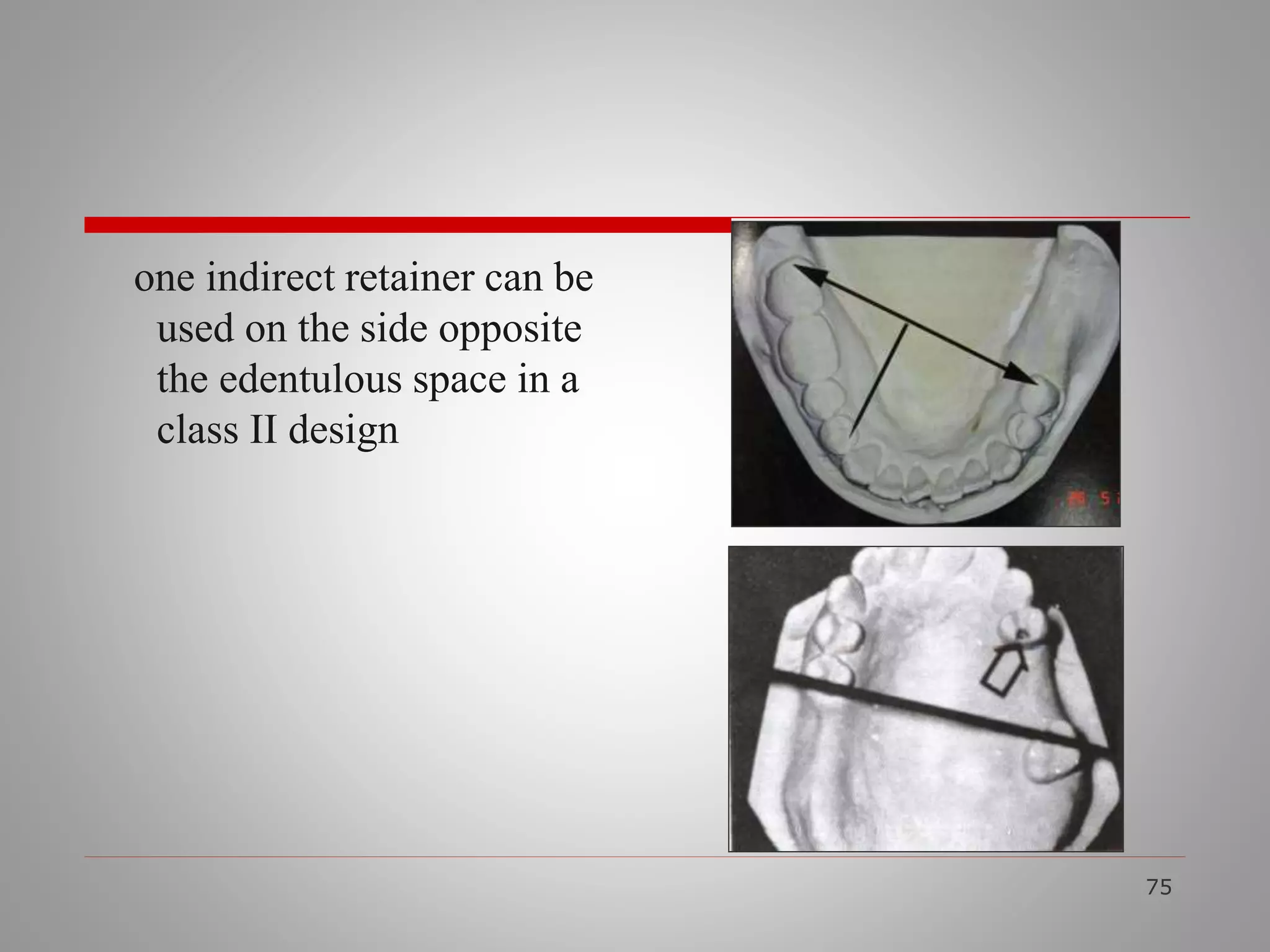 Designing for kennedy class i and class ii | PPT