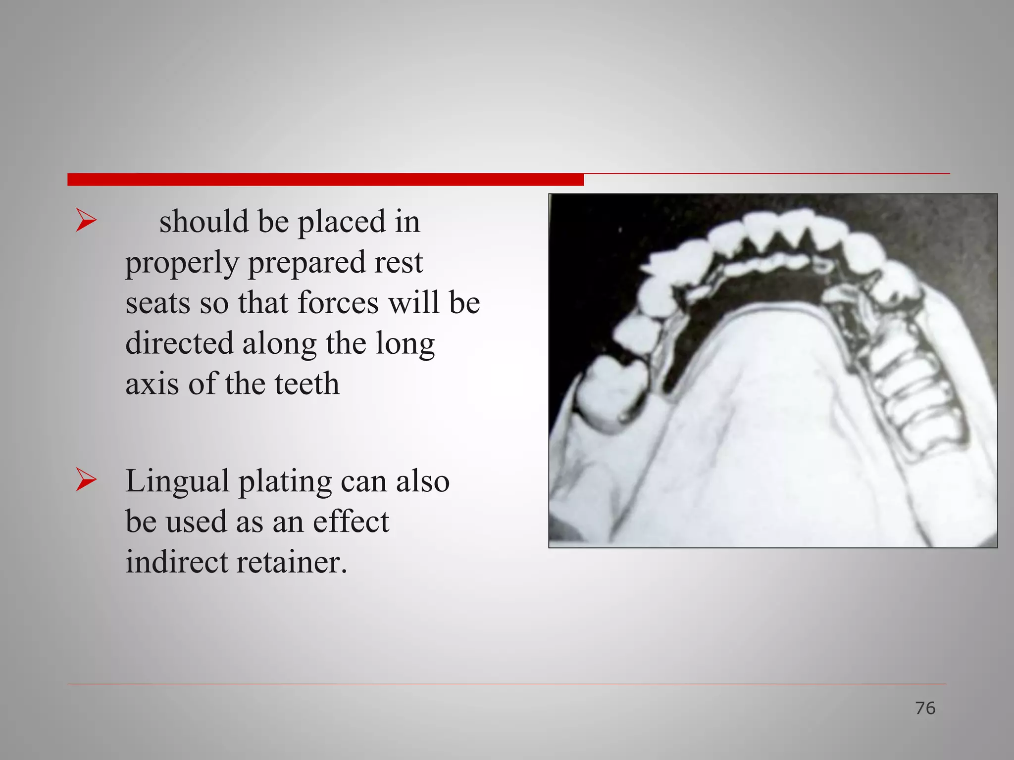 Designing for kennedy class i and class ii | PPT
