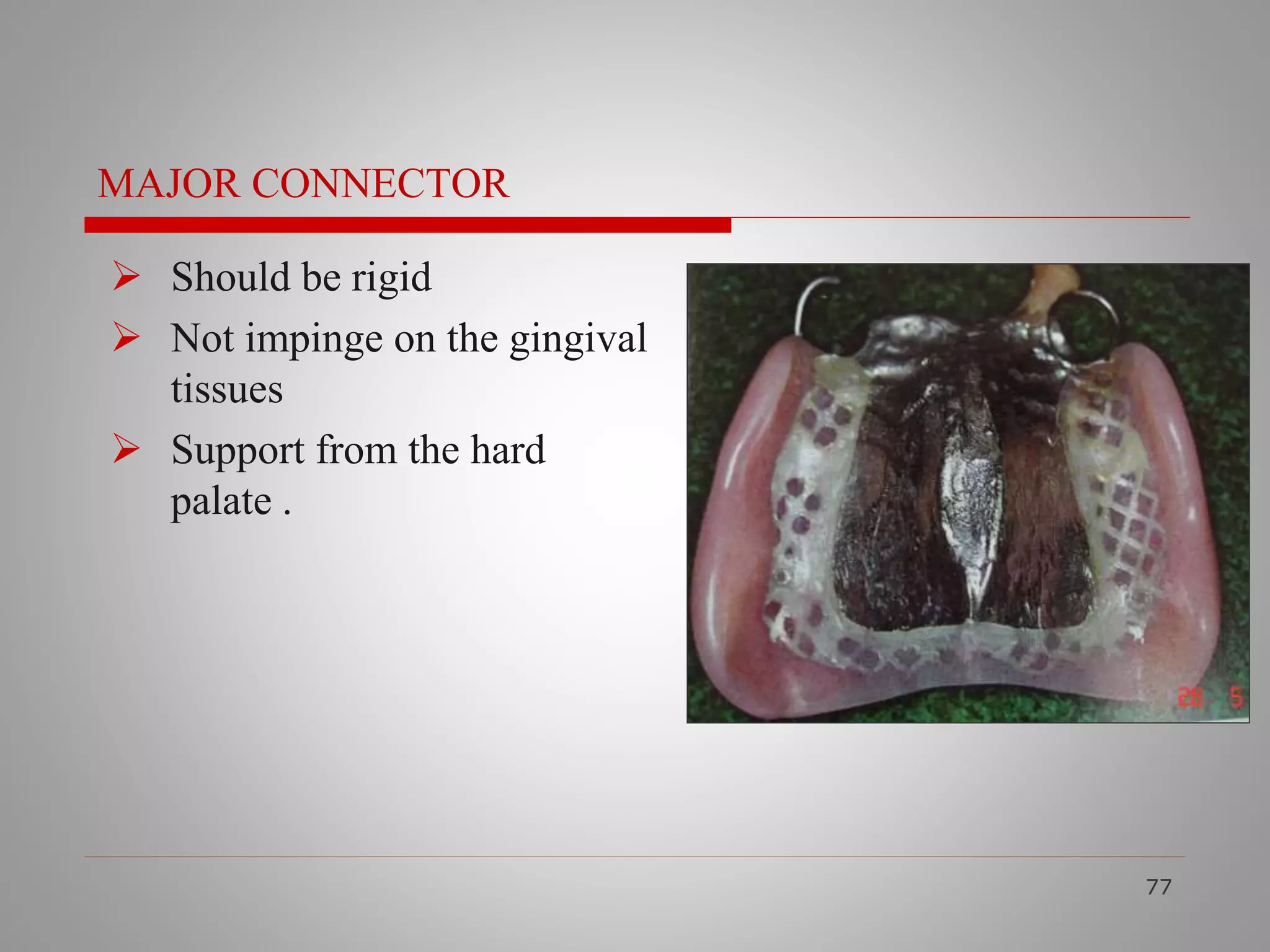 Designing for kennedy class i and class ii | PPT