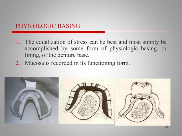 Designing for kennedy class i and class ii | PPT | Oral care | Personal ...