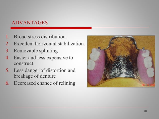 Designing for kennedy class i and class ii | PPT | Oral care | Personal ...