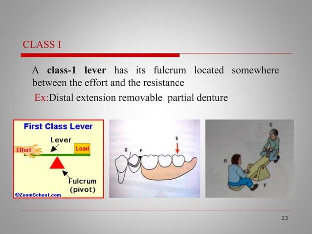 Designing for kennedy class i and class ii | PPT | Oral care | Personal ...