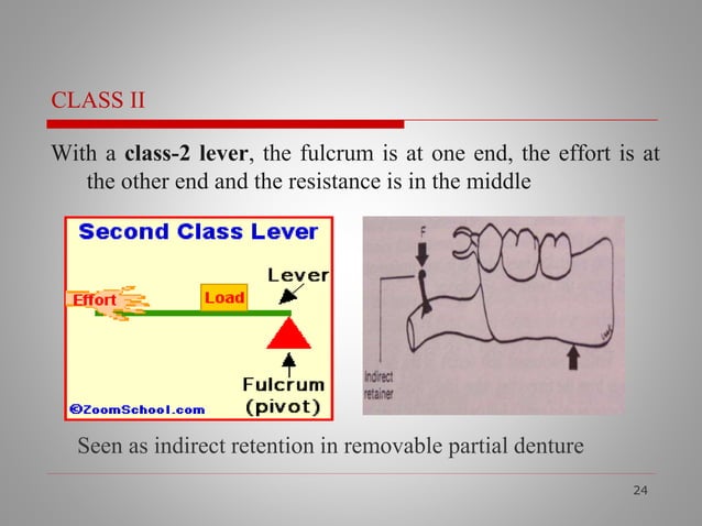 Designing For Kennedy Class I And Class Ii Ppt
