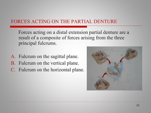 Designing for kennedy class i and class ii | PPT | Oral care | Personal ...