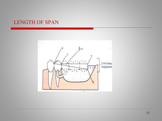 Designing for kennedy class i and class ii | PPT | Oral care | Personal ...