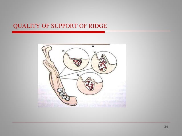 Designing for kennedy class i and class ii | PPT | Oral care | Personal ...