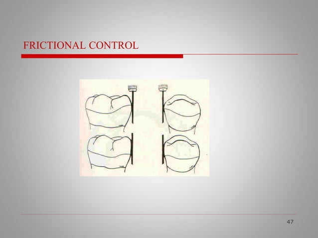 Designing for kennedy class i and class ii | PPT | Oral care | Personal ...