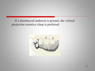 Designing for kennedy class i and class ii | PPT
