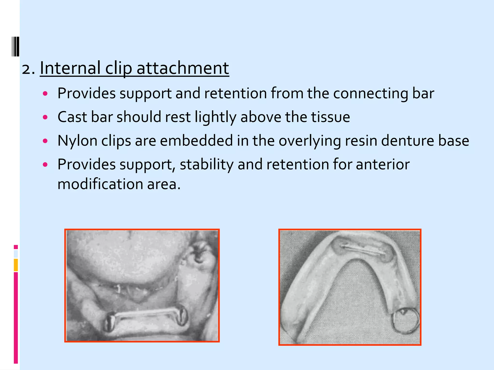 Designing for kennedys cl iii & iv | PPT