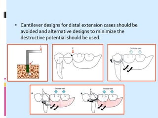 Designing for kennedys cl iii & iv | PPT