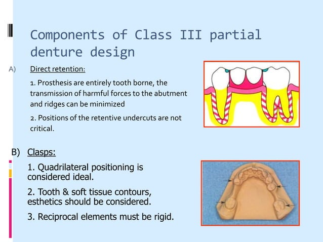 Designing for kennedys cl iii & iv | PPT