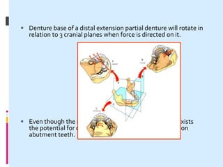 Designing for kennedys cl iii & iv | PPT
