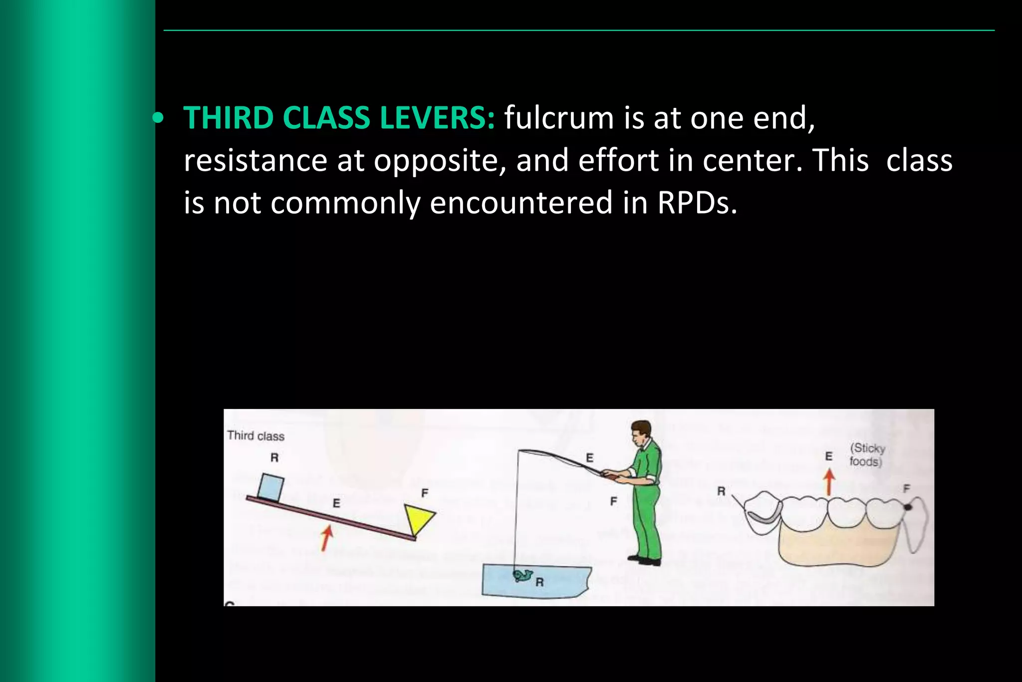 Designing of rpd | PPTX | Dental Health | Diseases and Conditions