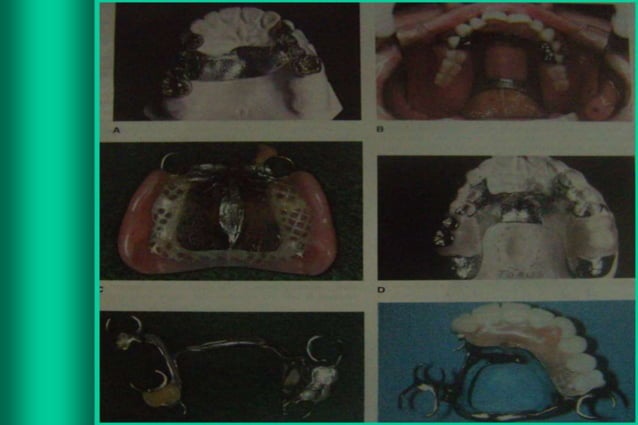Designing of rpd | PPTX | Dental Health | Diseases and Conditions