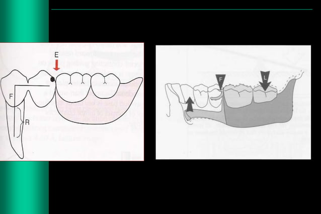 Designing of rpd | PPTX | Dental Health | Diseases and Conditions
