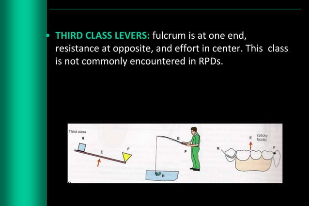 Designing of rpd | PPTX | Dental Health | Diseases and Conditions