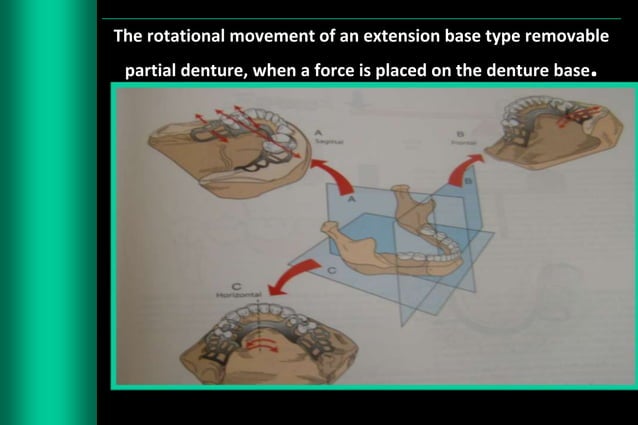 Designing of rpd | PPTX | Dental Health | Diseases and Conditions