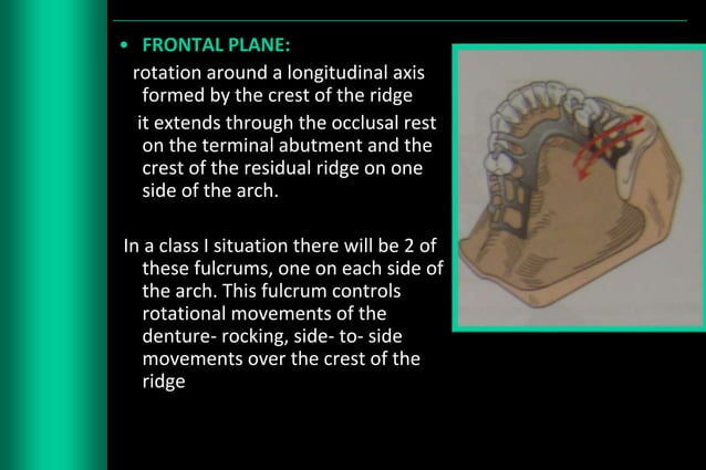 Designing of rpd | PPTX | Dental Health | Diseases and Conditions
