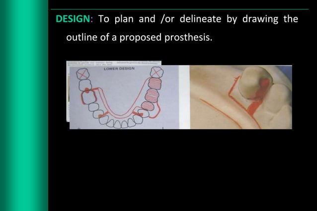 Designing of rpd | PPTX | Dental Health | Diseases and Conditions