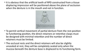 designing principles of Removable partial denture.pptx