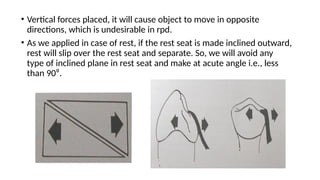 designing principles of Removable partial denture.pptx