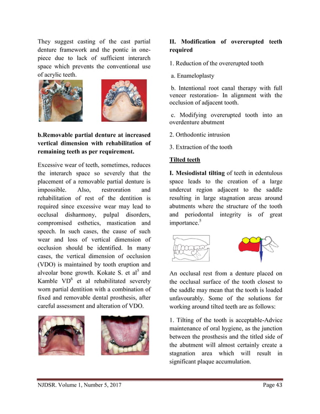 Designing removable partial dentures around difficult dentition | PDF