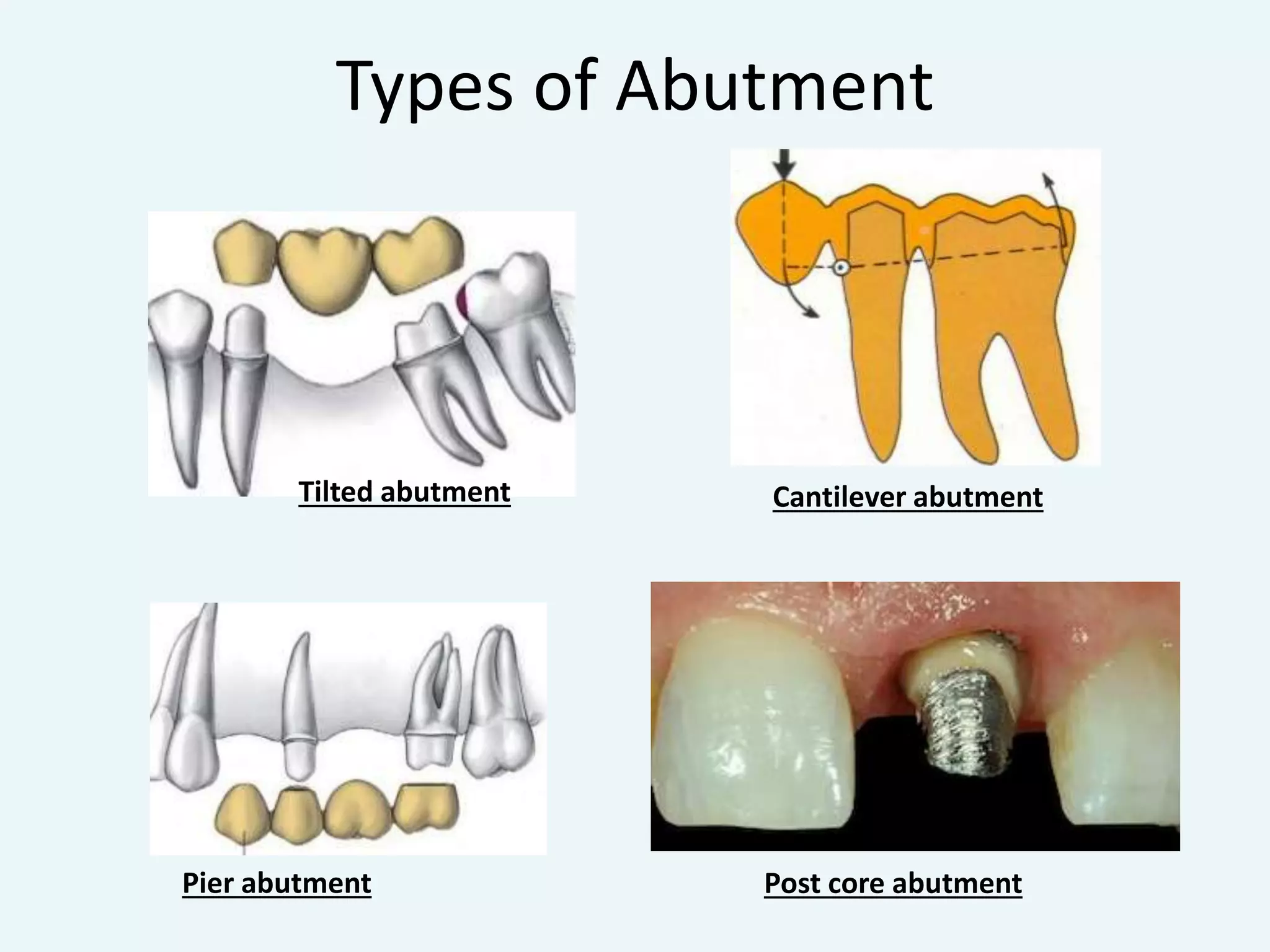 Design of a fixed Partial Denture (with Abutment Tooth Preparation) | PPTX