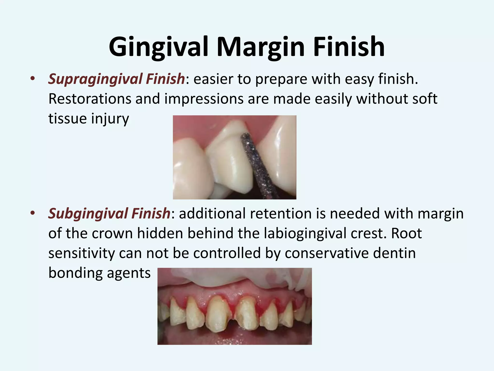 Design of a fixed Partial Denture (with Abutment Tooth Preparation) | PPTX