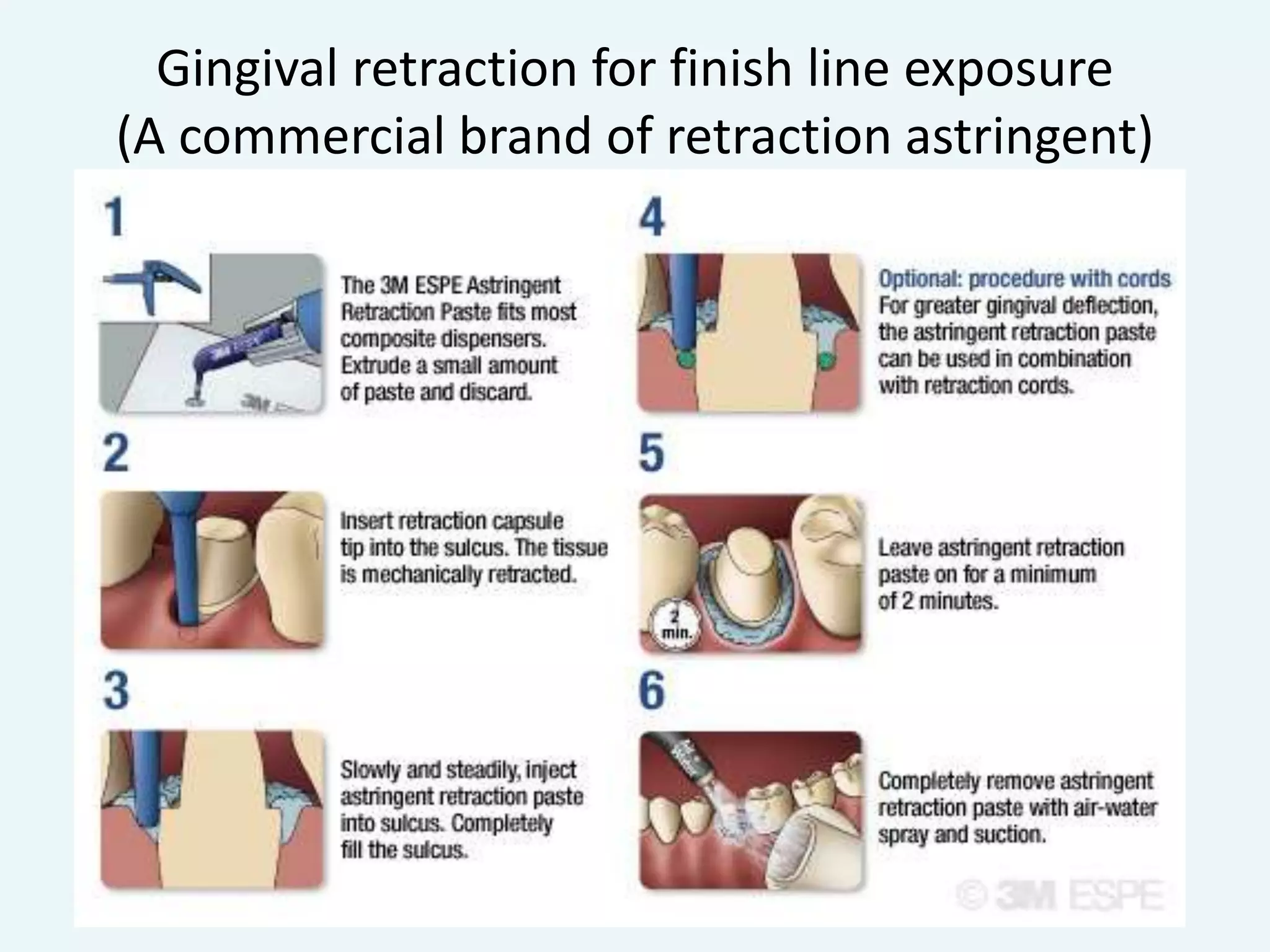 Design of a fixed Partial Denture (with Abutment Tooth Preparation) | PPTX