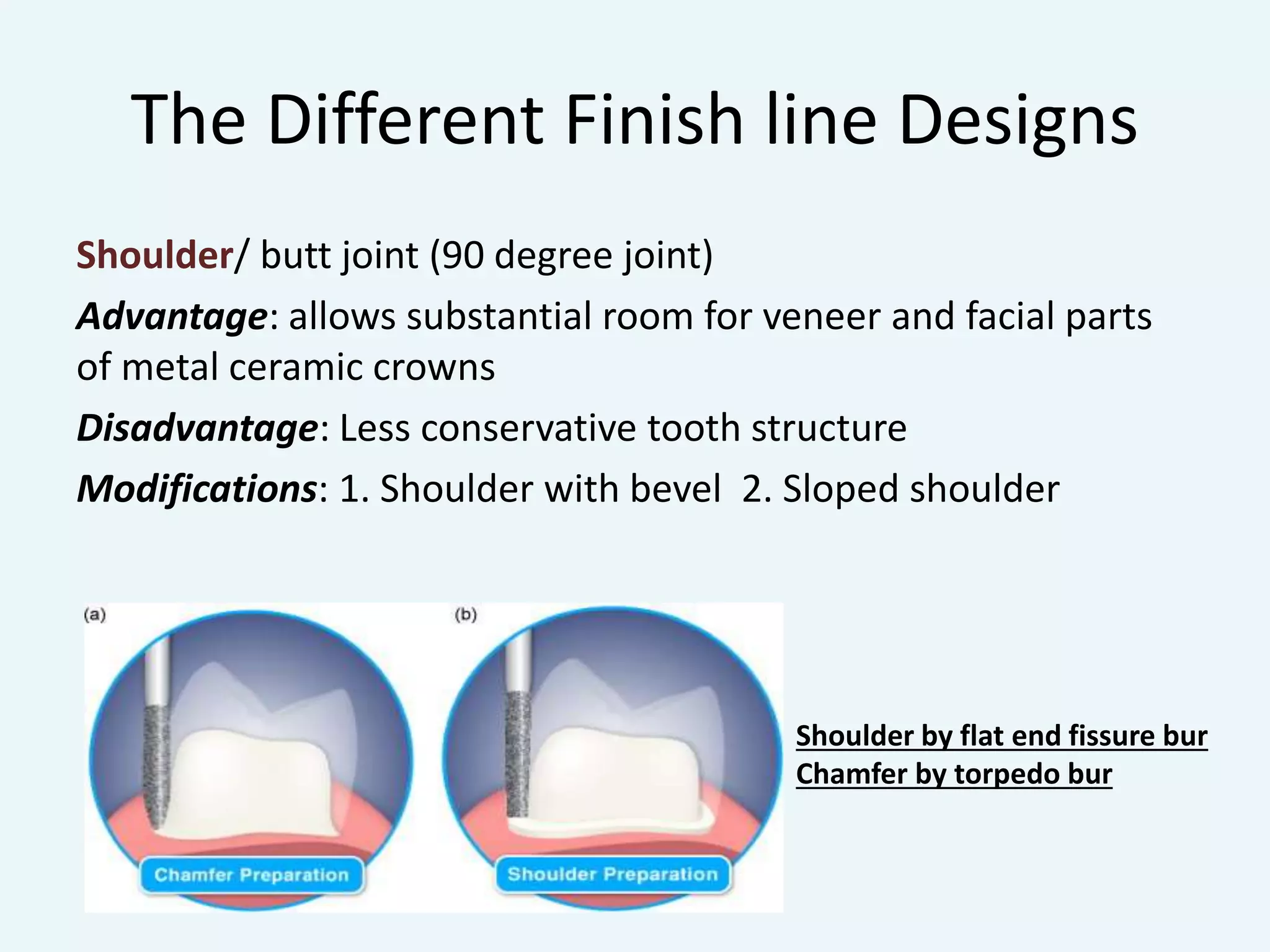 Design of a fixed Partial Denture (with Abutment Tooth Preparation) | PPTX