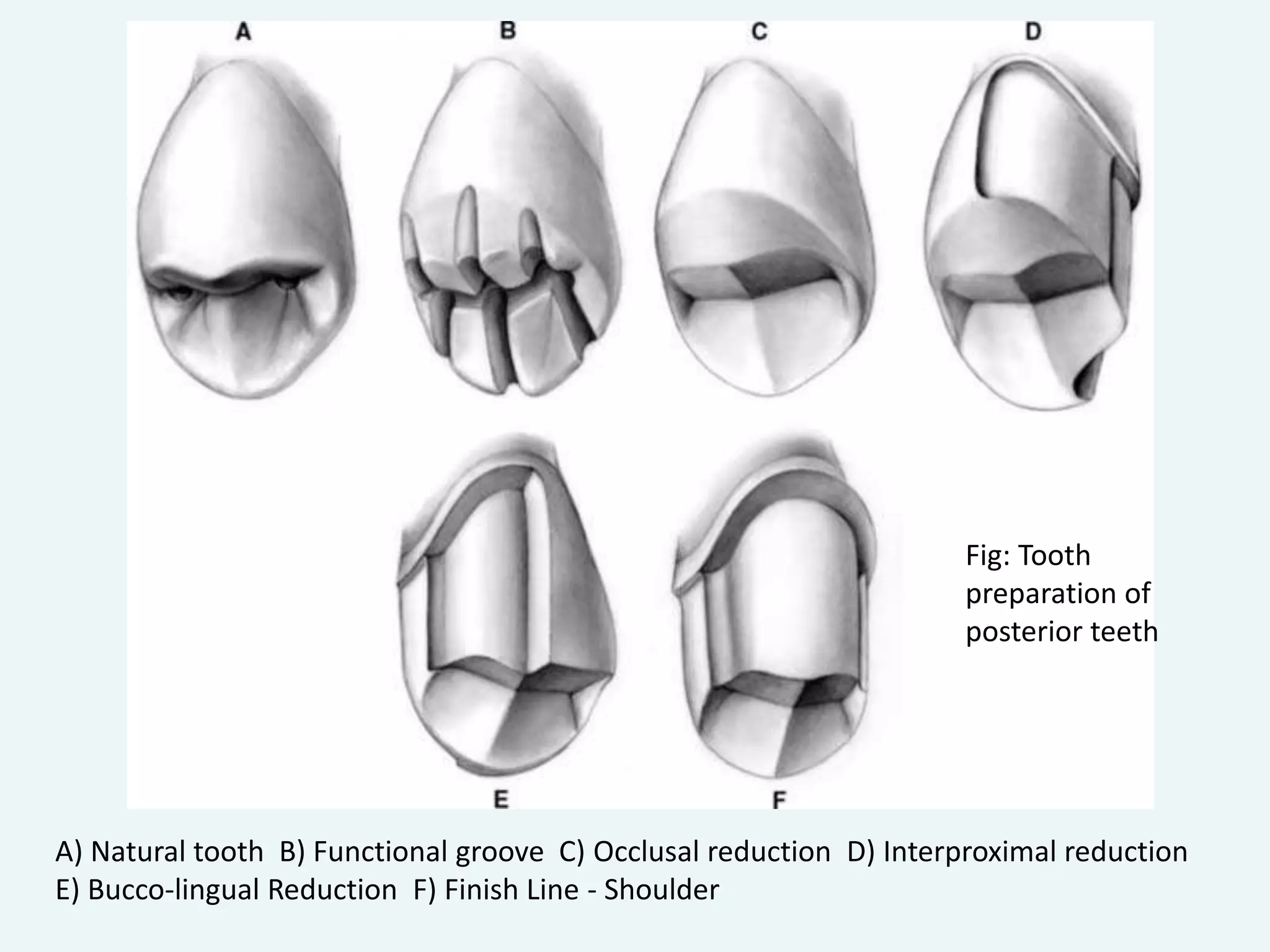Design of a fixed Partial Denture (with Abutment Tooth Preparation) | PPTX