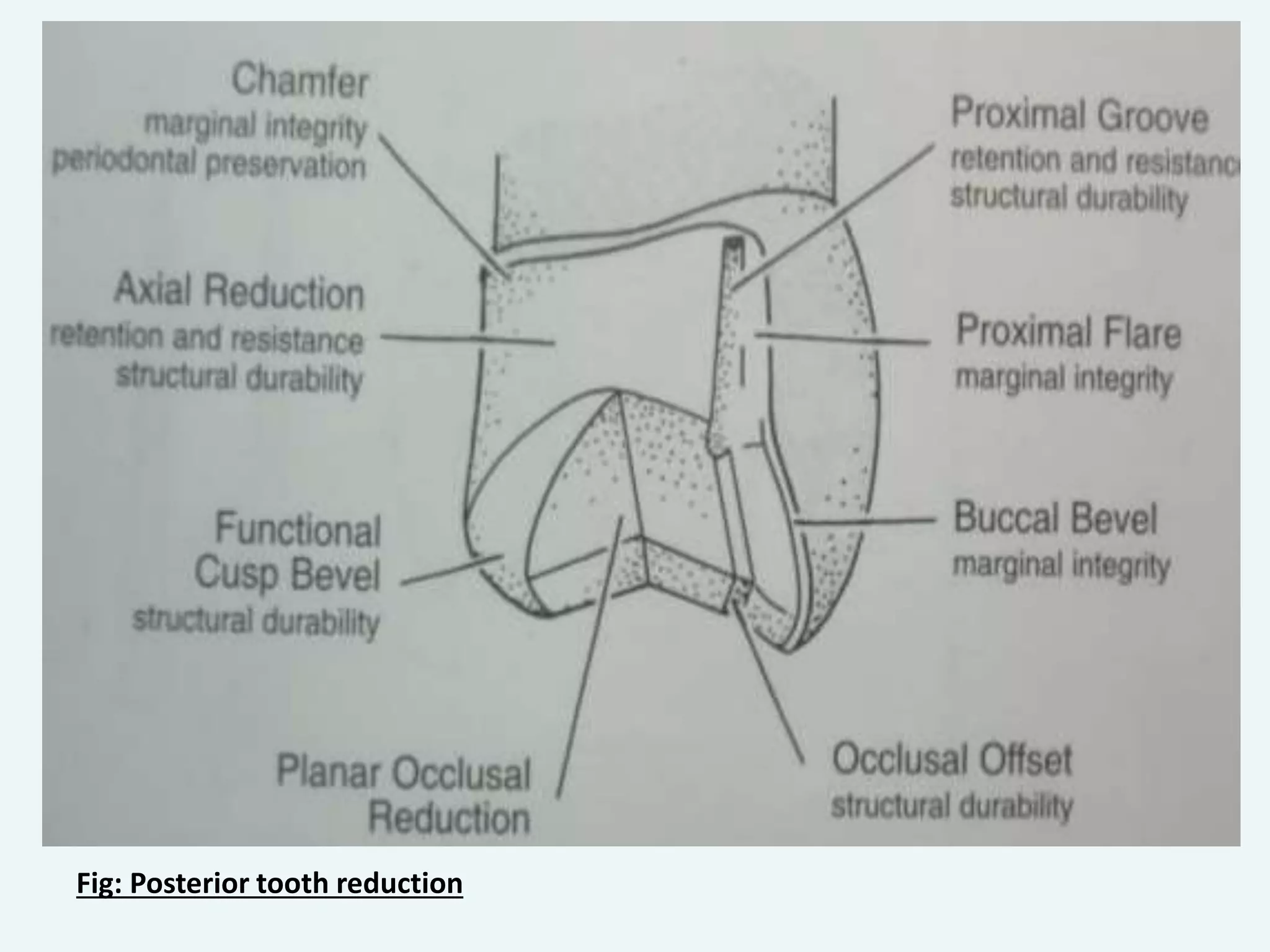 Design of a fixed Partial Denture (with Abutment Tooth Preparation) | PPTX